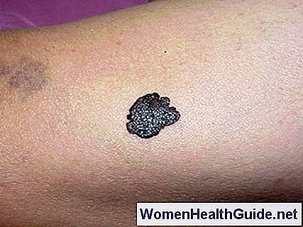 Soorten huidkanker - foto's en behandeling 💊 NL.WomenHealthGuide.net