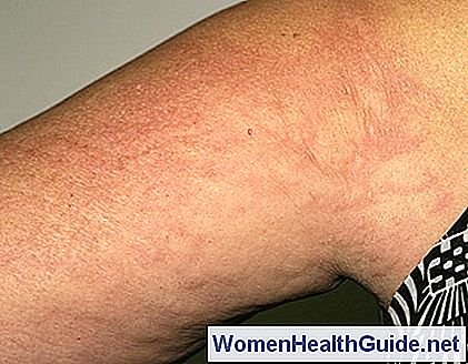 Urticaria (Hives, Itchy Red Skin Welts) och angioödem (svullnad) 💊 SV ...