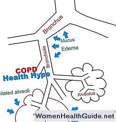 Wat is COPD? Wat veroorzaakt chronische obstructieve longziekte? 💊 NL ...
