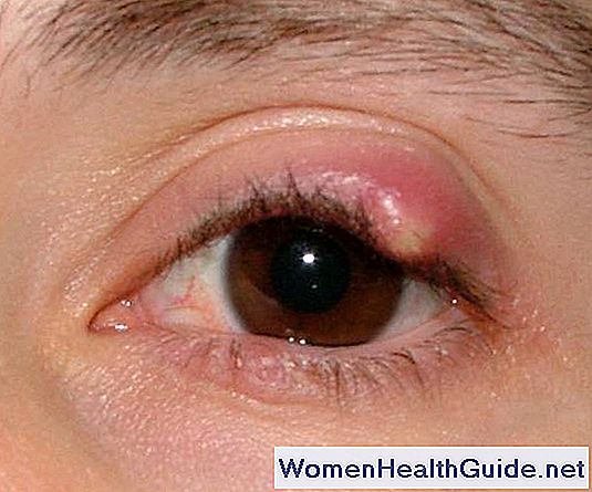 Chalazion (ooglid-cyste) Oorzaken, symptomen, behandeling 💊 NL ...