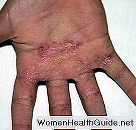 Jeukende vingers Oorzaken, foto's, behandeling 💊 NL.WomenHealthGuide.net